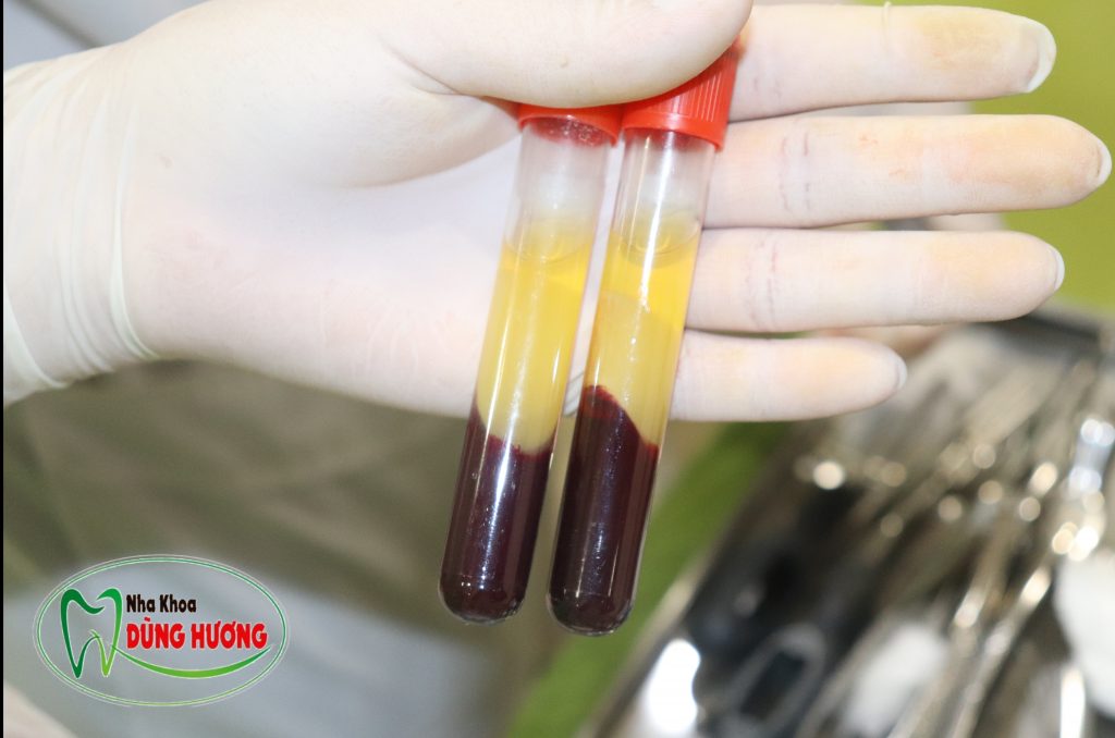 CÔNG NGHỆ GHÉP MÀNG PRF - Nha Khoa Dũng Hương